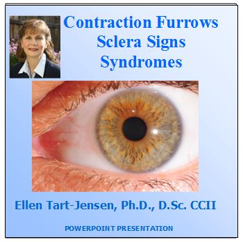 Contraction Furrows, Sclera Signs, and Syndromes ~ CD-ROM PPP - Ellen ...